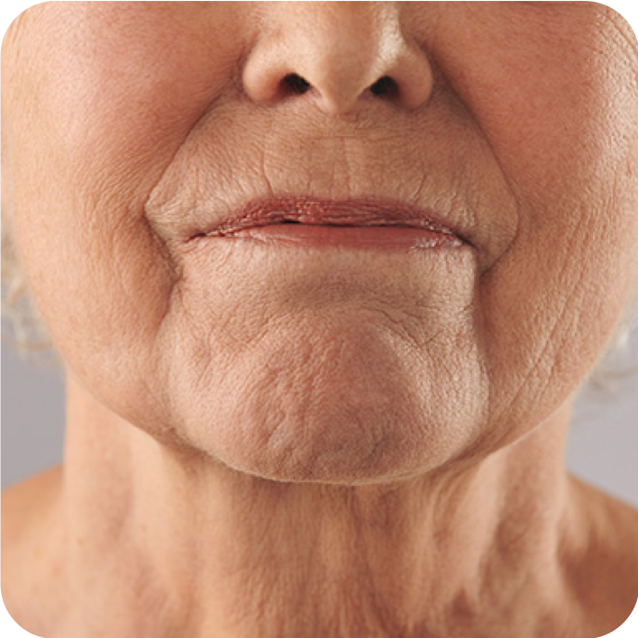 Marionette Lines Treating Marionette Lines Facial Acupuncture